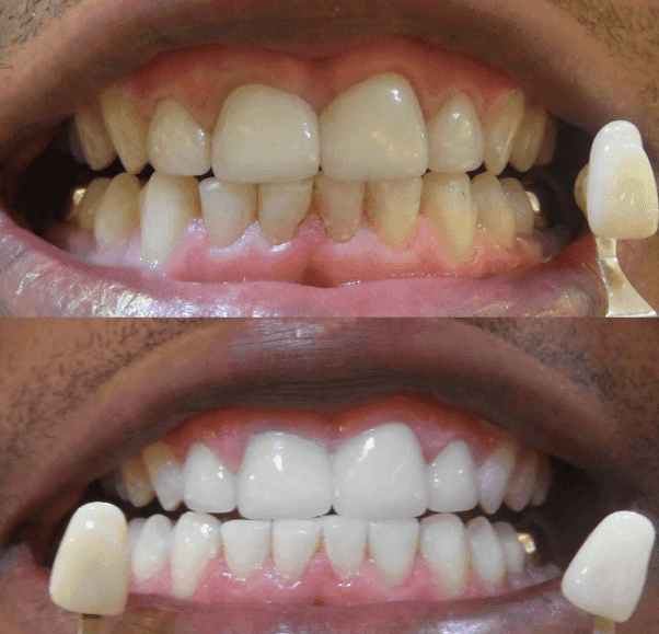 Teeth Whitening - Afterglow Tanning & Wellness